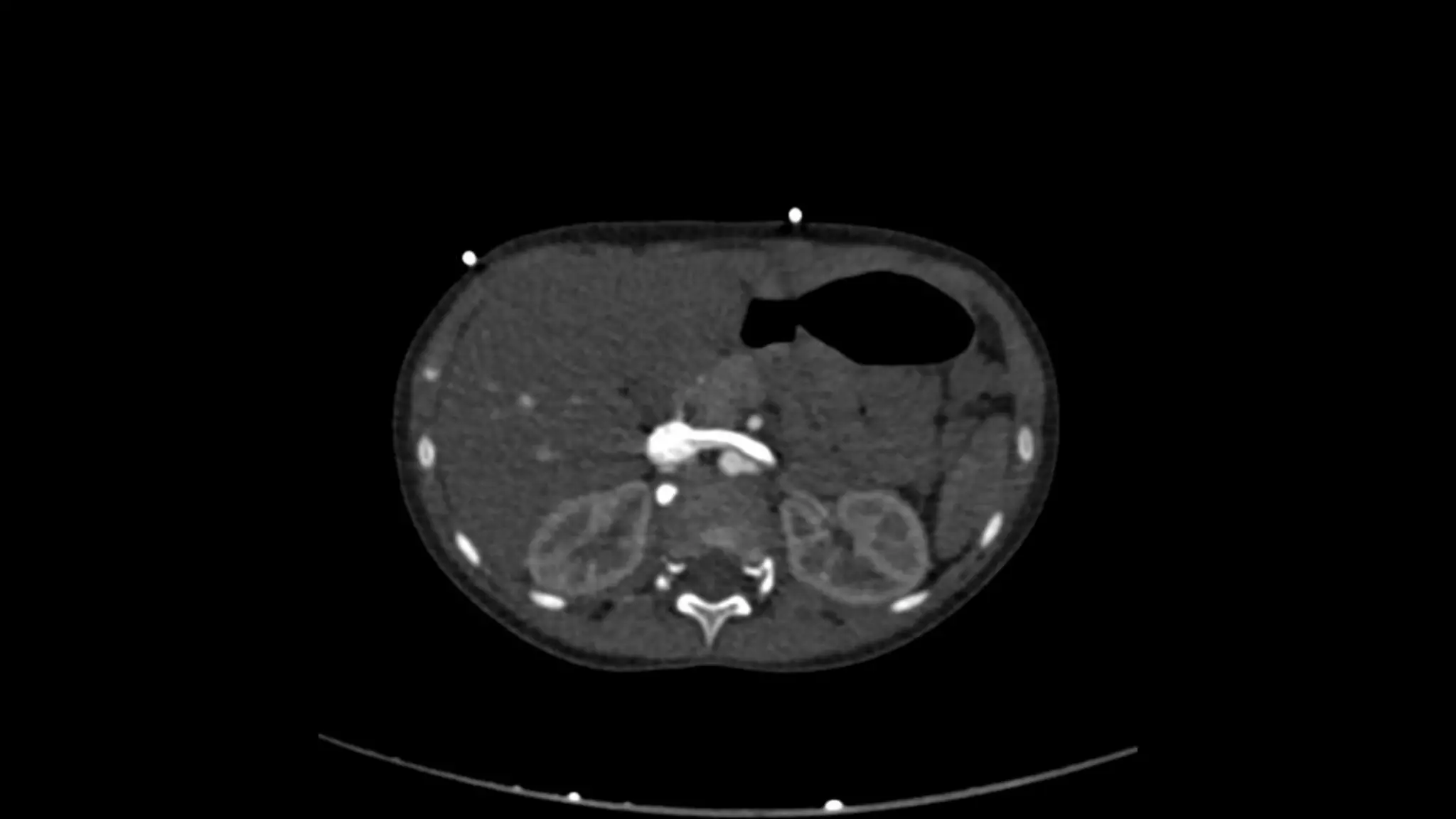 Criss cross , Veno-venous collaterals , TGA | PPTX