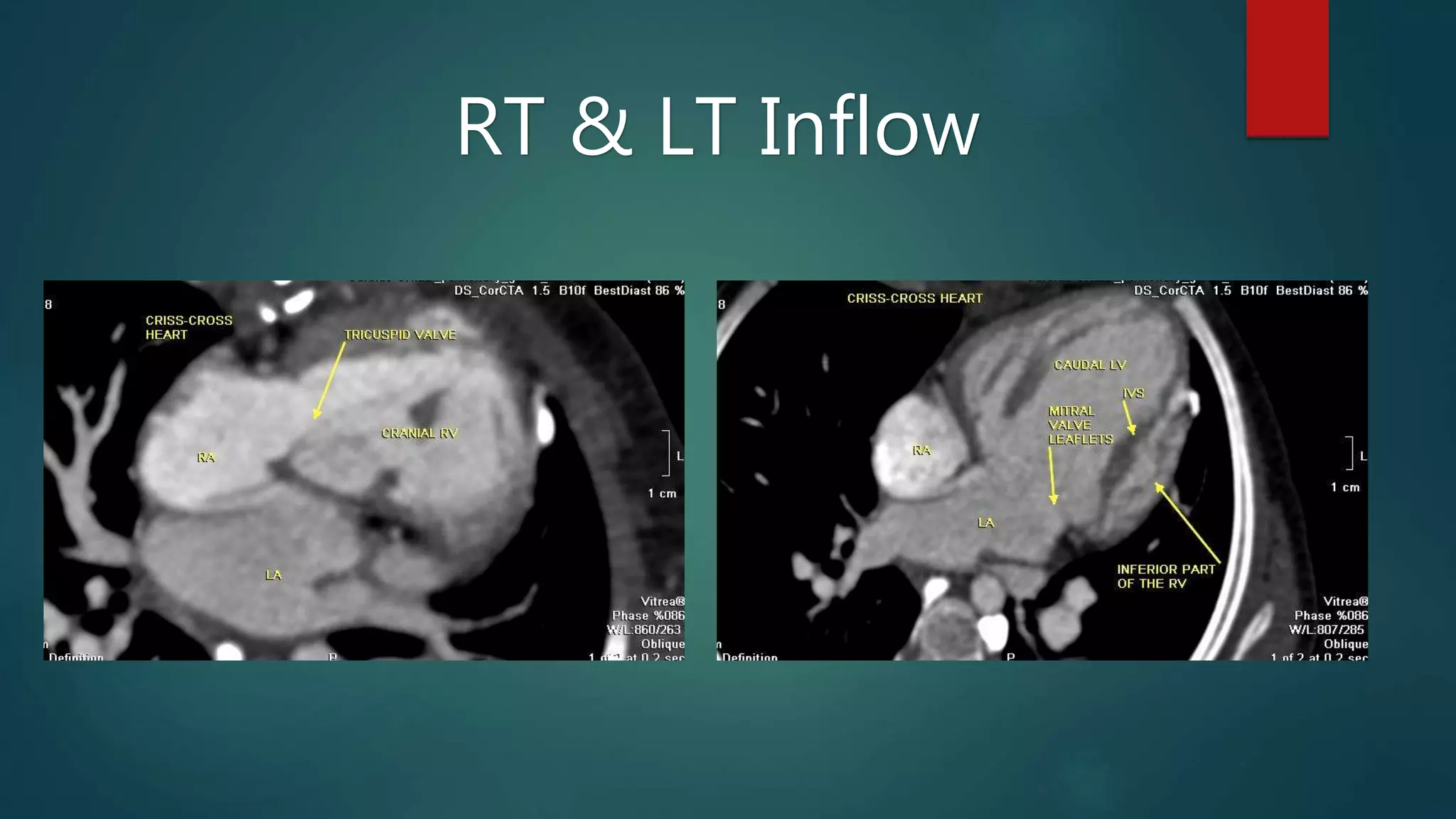 Criss cross , Veno-venous collaterals , TGA | PPTX