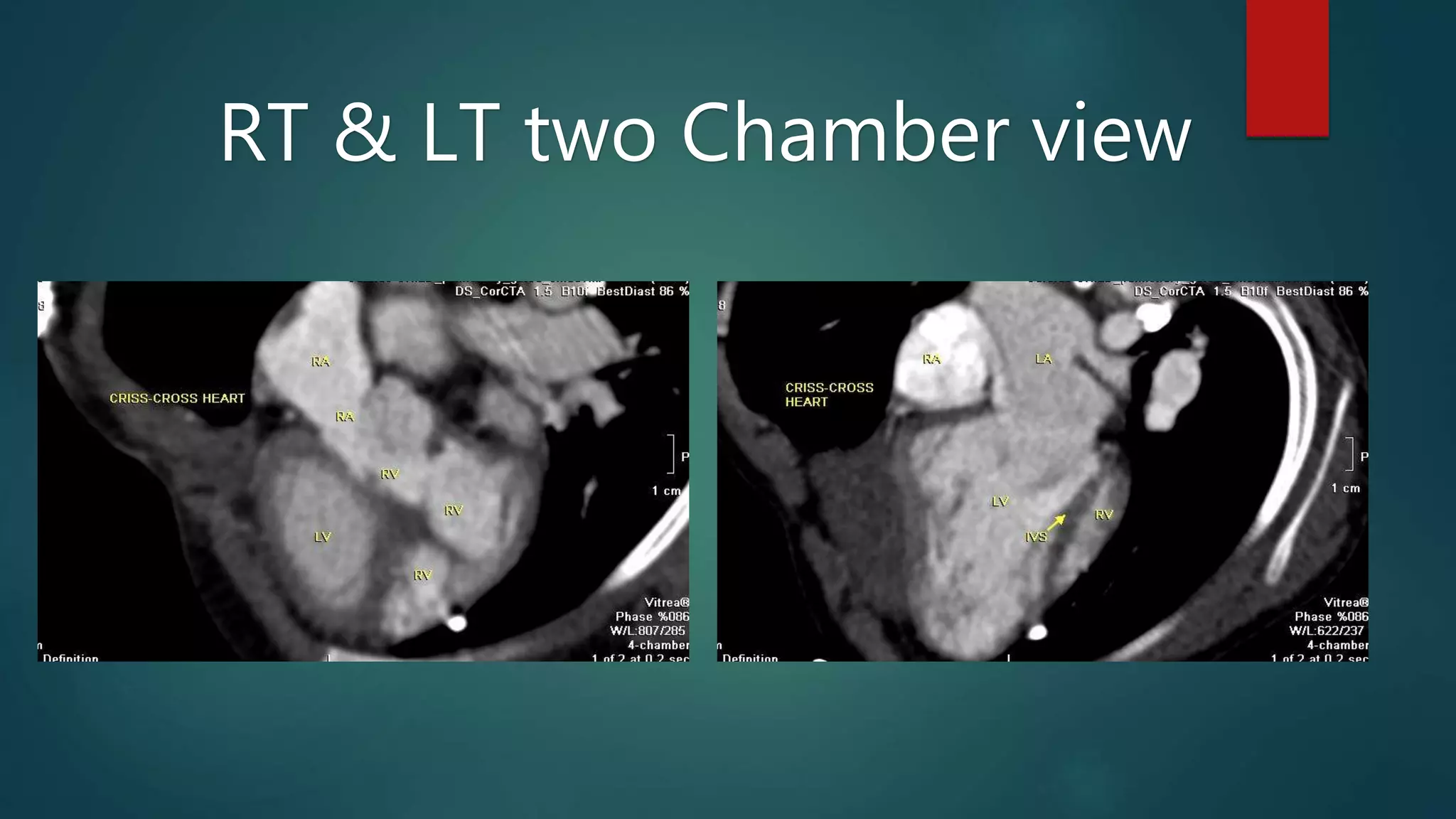 Criss cross , Veno-venous collaterals , TGA | PPTX