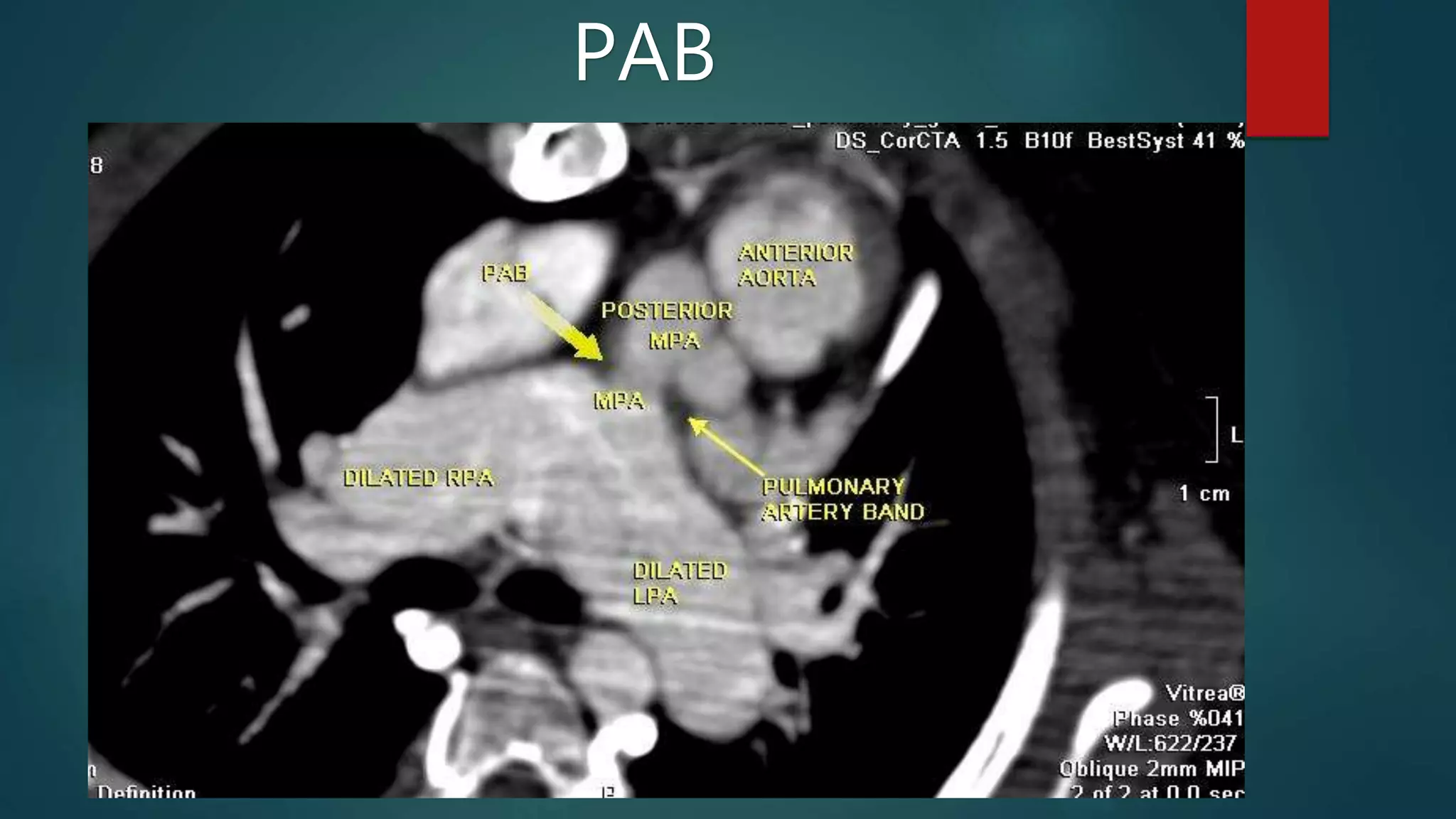 Criss cross , Veno-venous collaterals , TGA | PPTX