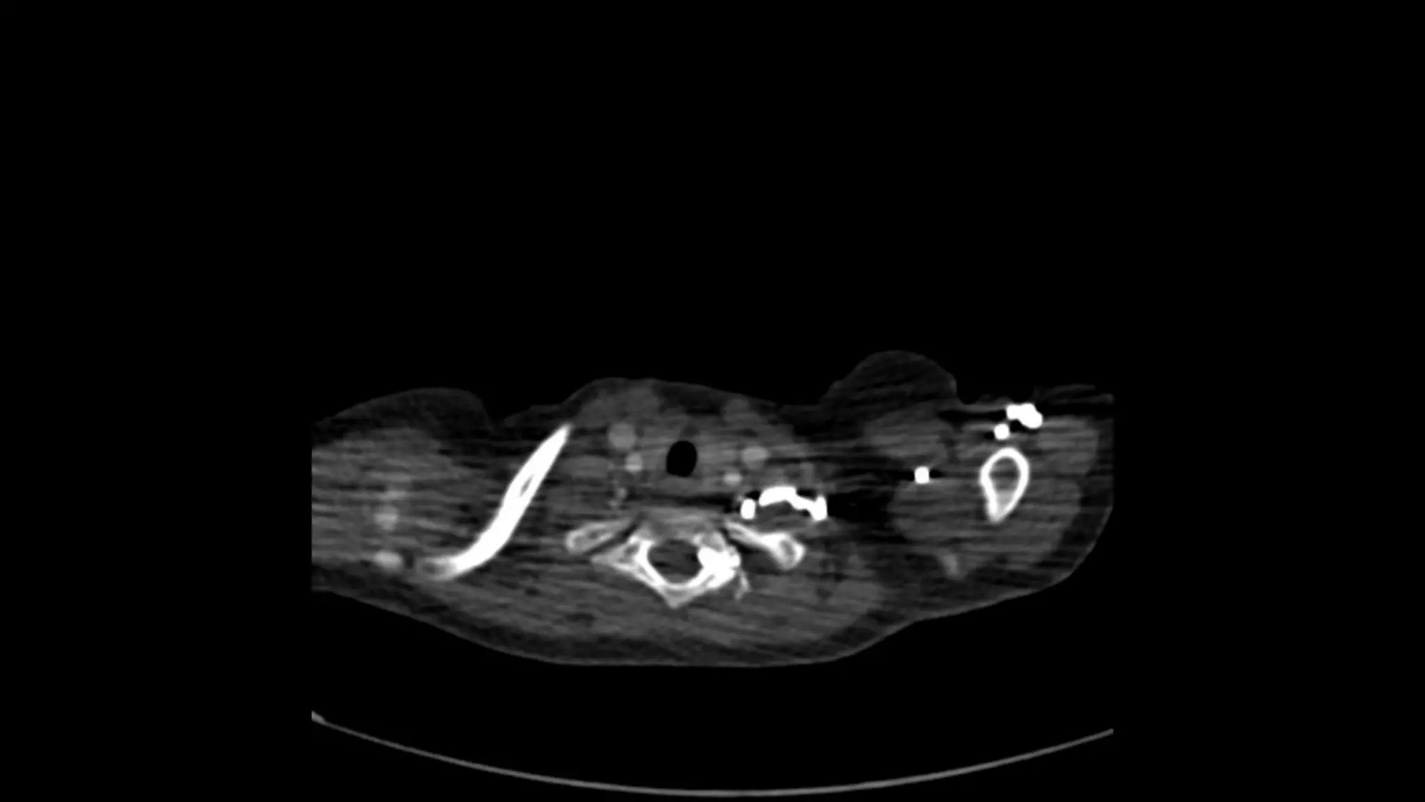 Criss cross , Veno-venous collaterals , TGA | PPTX