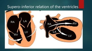 Criss cross , Veno-venous collaterals , TGA | PPTX