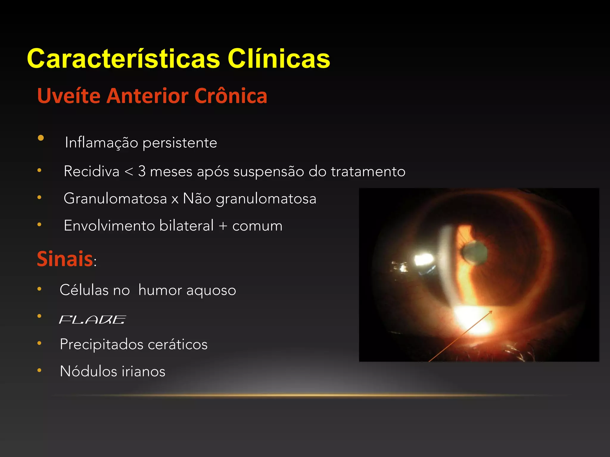 Cristalino Úvea - Catarata e Uveíte | PPT