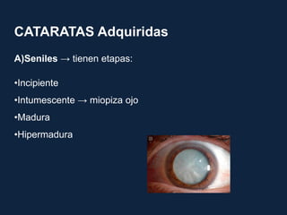 Cristalino y Cataratas | PPT