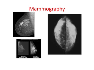 Criteria for suggesting mammogram or ultrasound screening | PPTX