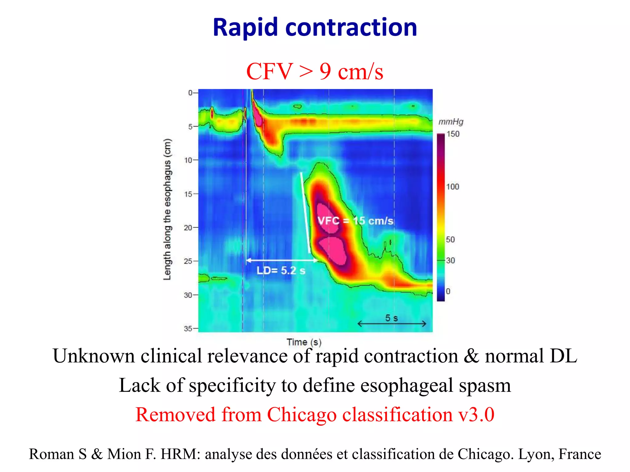 Normal & abnormal swallows in chicago classification version 3.0 | PPT