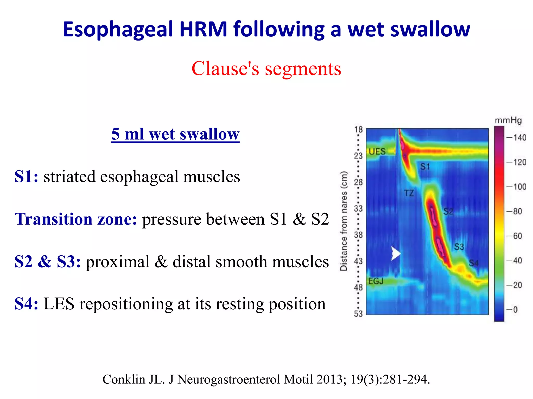 Normal & abnormal swallows in chicago classification version 3.0 | PPT