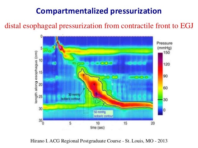 Normal & abnormal swallows in chicago classification version 3.0