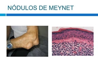 Criterios de jones para artritis reumatoide | PPTX