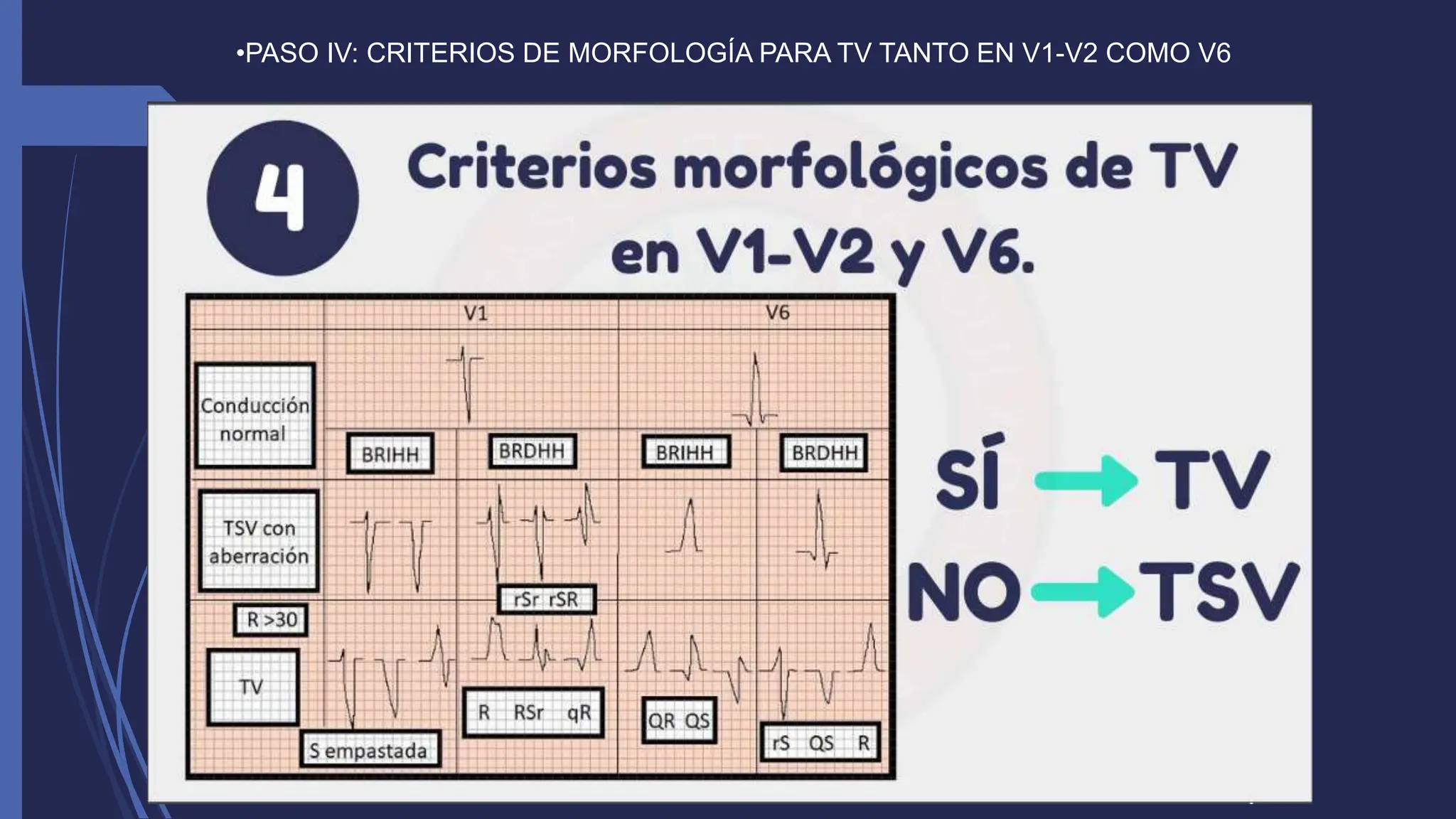 CRITERIOS DE TAQUICARDIA VENTRICULAR.pptx