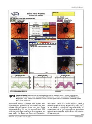 Criterios diagnosticos en glaucoma | PDF
