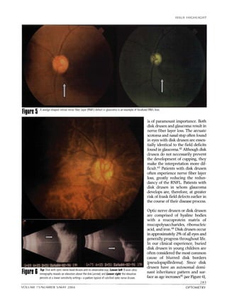 Criterios diagnosticos en glaucoma | PDF