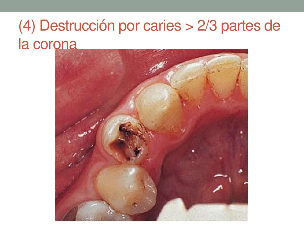 Criterios magnitud de la lesión cariosa