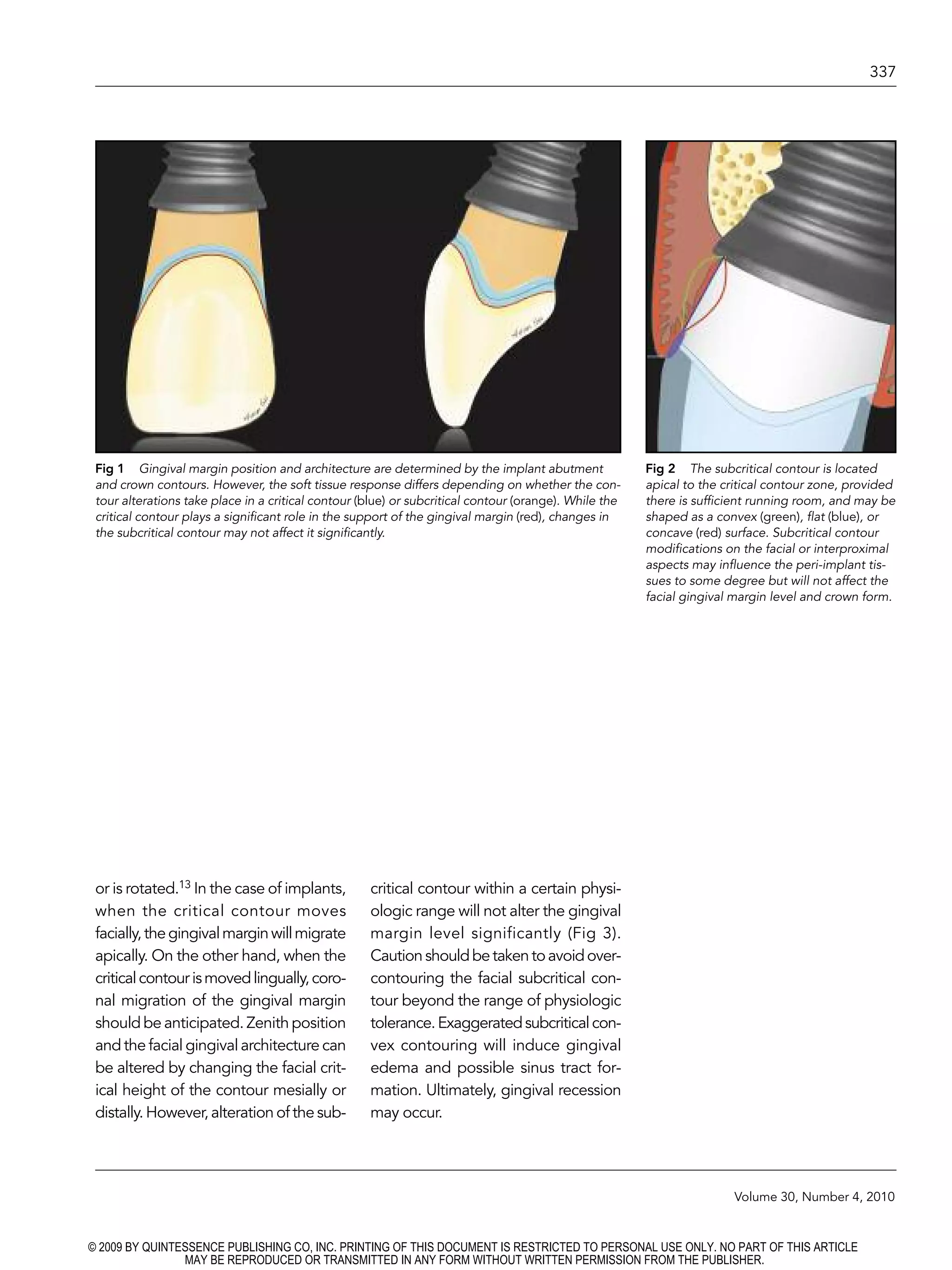 Considerations of Implant Abutment and Crown Contour: Critical Contou…