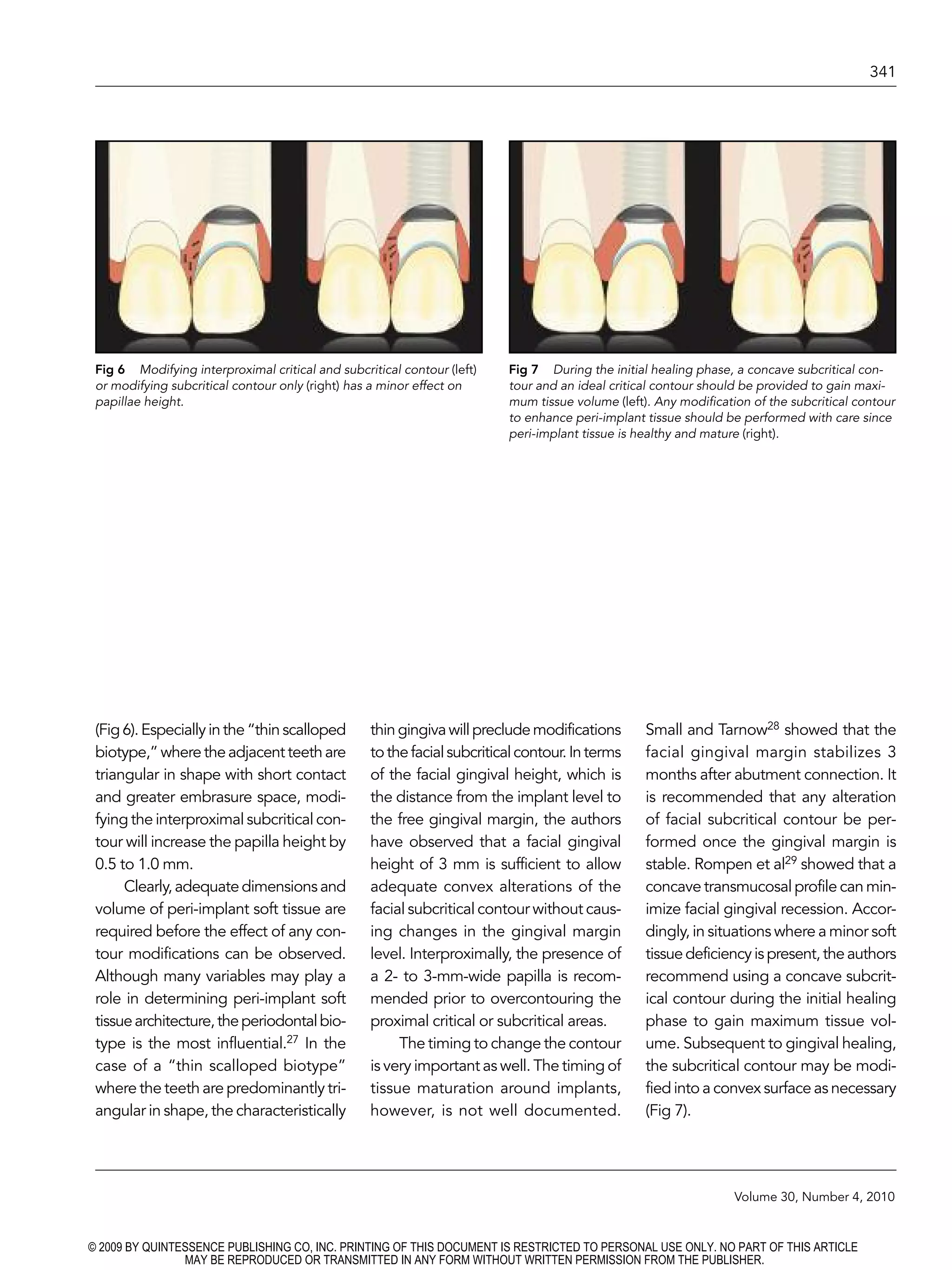 Considerations of Implant Abutment and Crown Contour: Critical Contou…