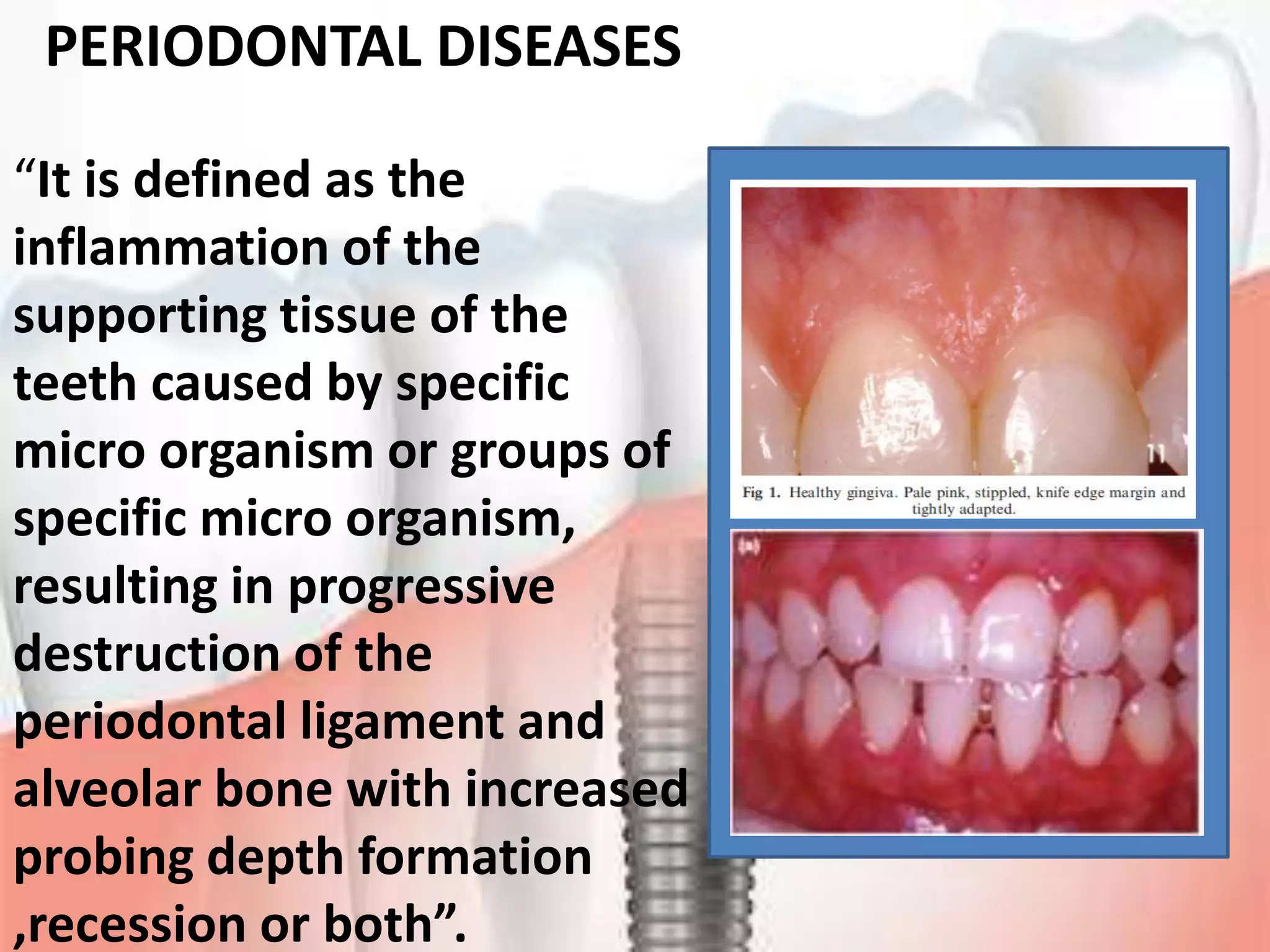 Critical apprisal of 2018 classification of periodontal disease | PPTX