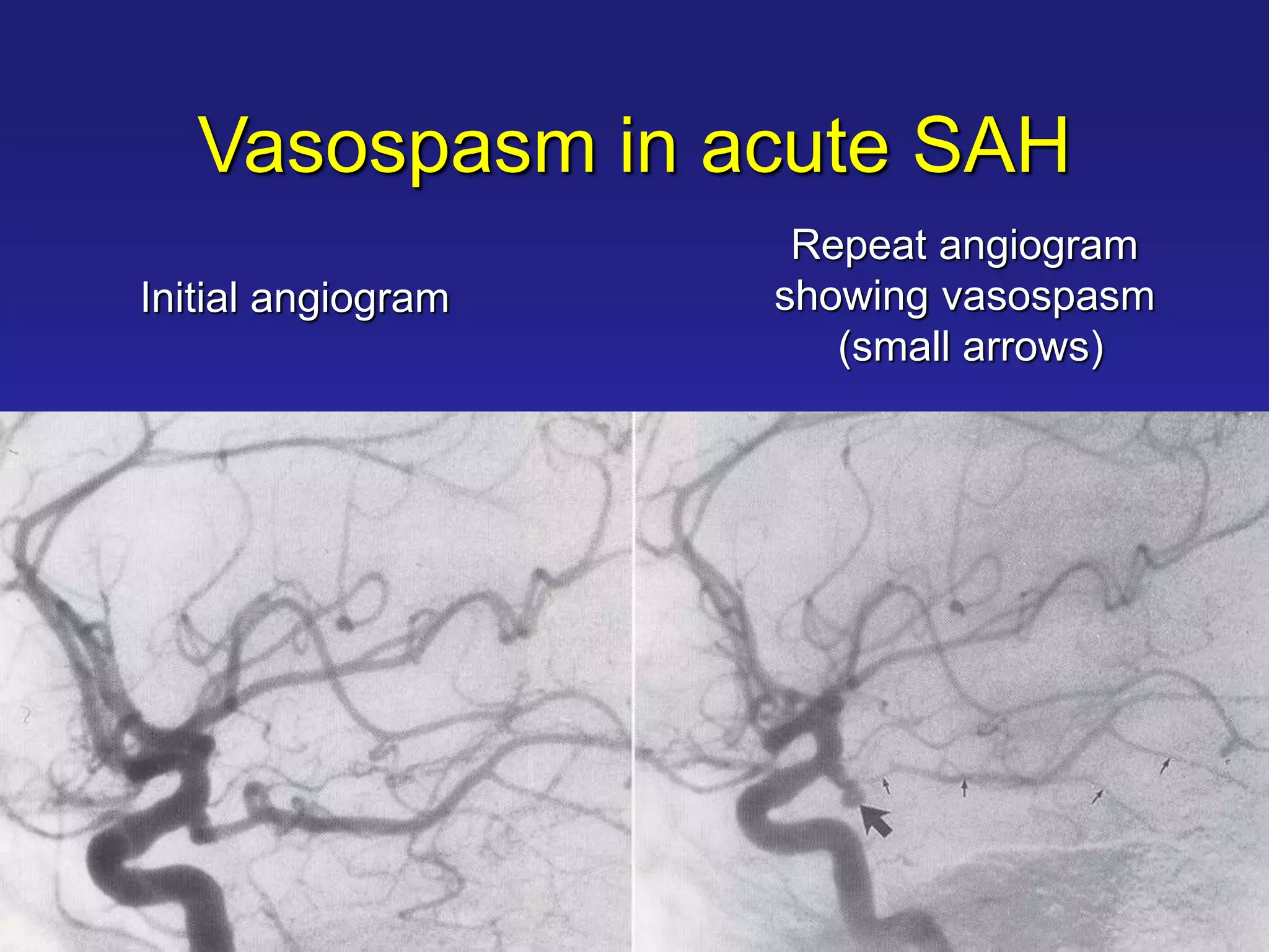 Critical care of the patient with acute subarachnoid hemorrhage.ppt