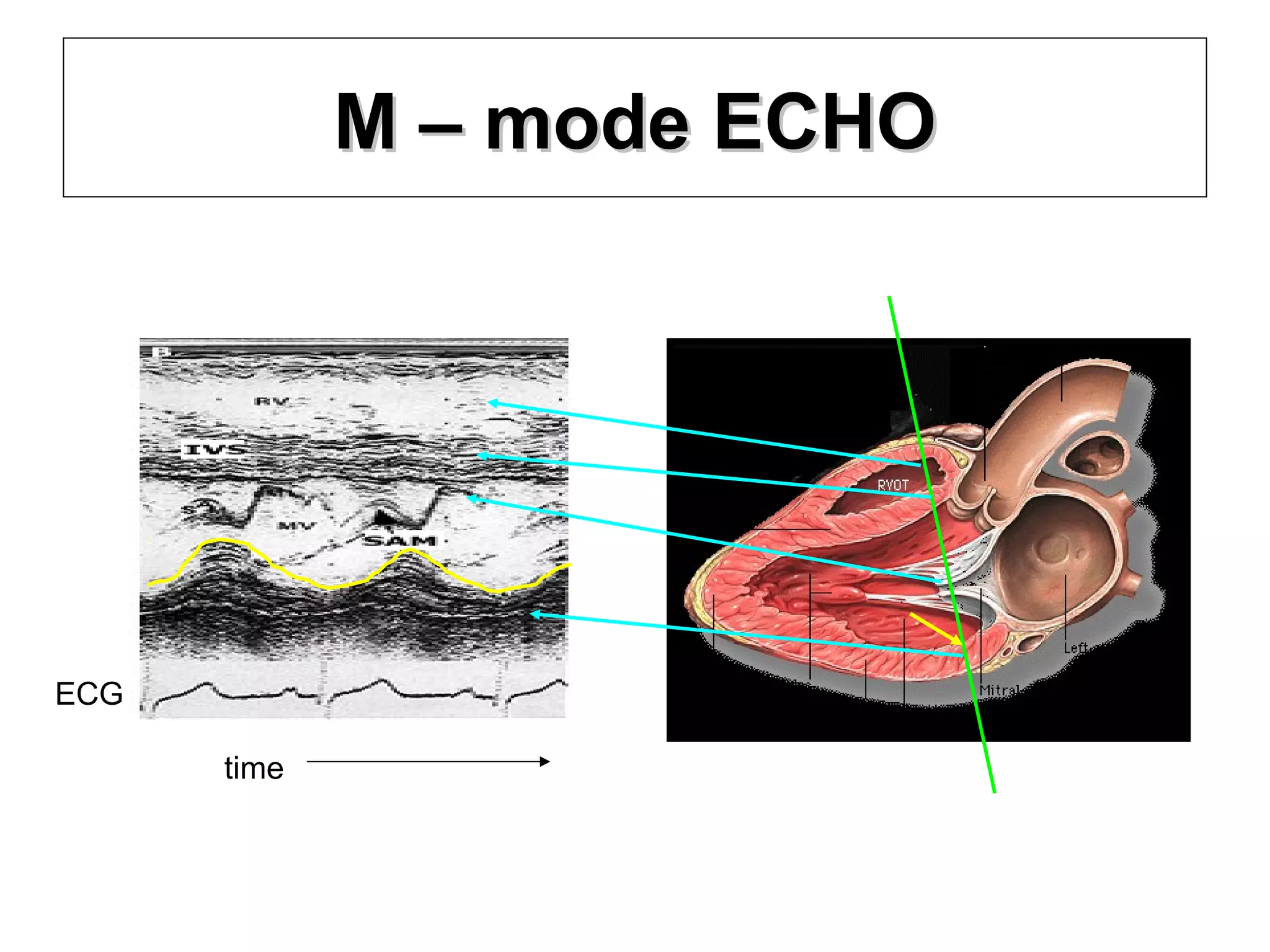Systolic anterior motion of mitral valve - SAM | PPT