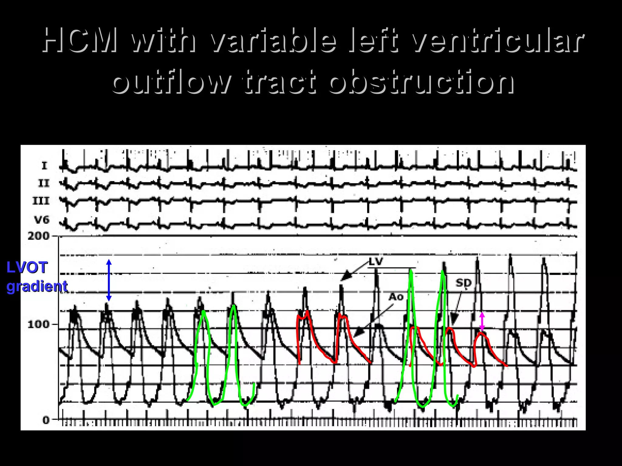 Systolic anterior motion of mitral valve - SAM | PPT | Heart and ...