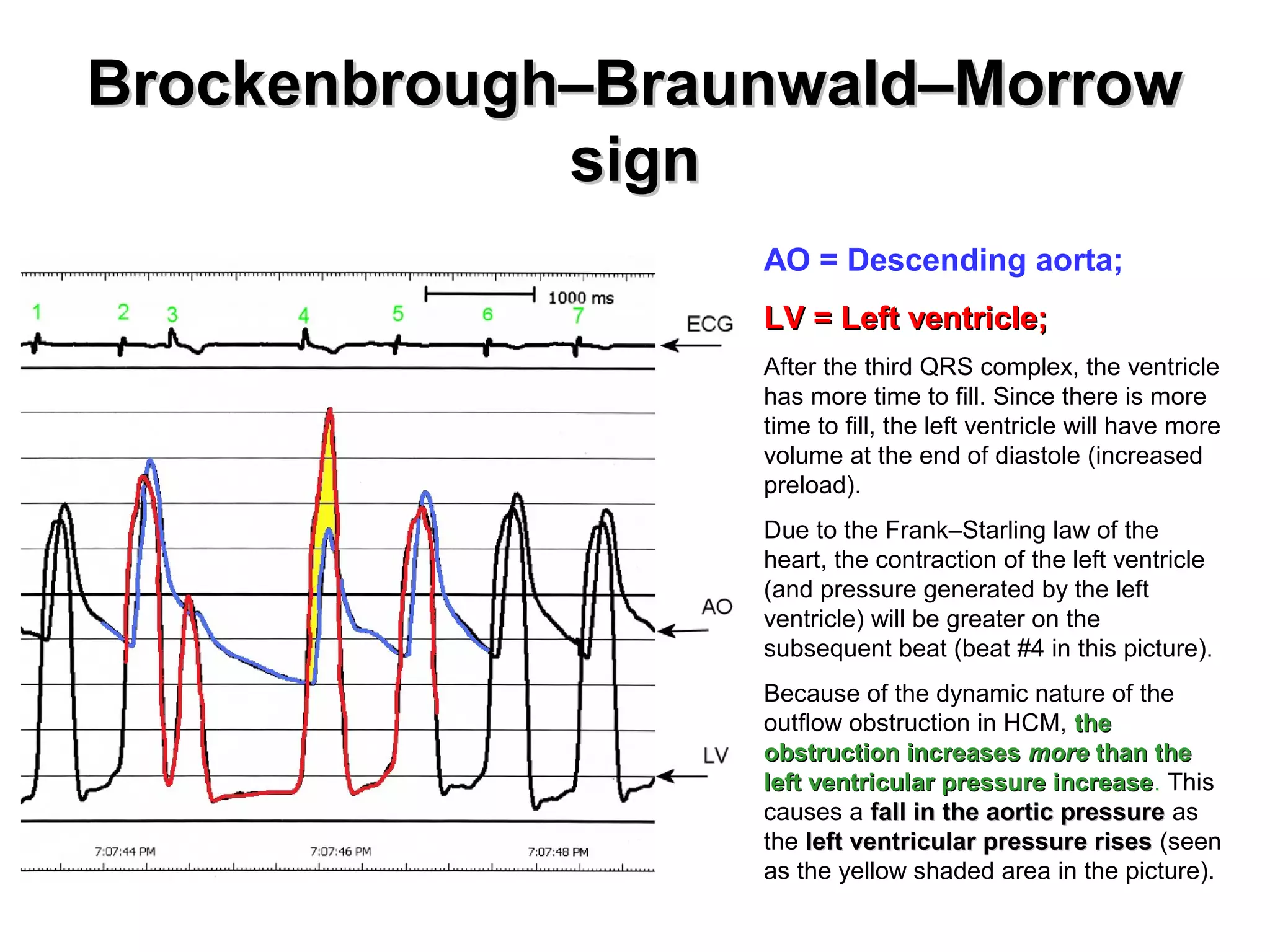 Systolic anterior motion of mitral valve - SAM | PPT | Heart and ...