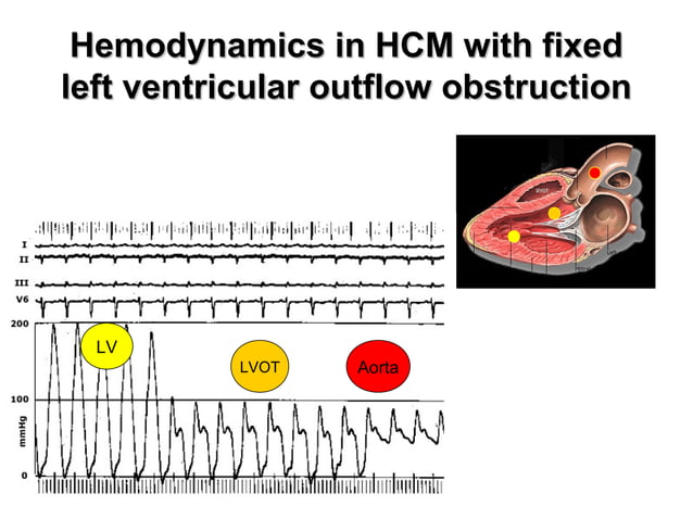 Systolic anterior motion of mitral valve - SAM | PPT | Heart and ...