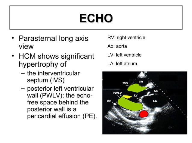 Systolic anterior motion of mitral valve - SAM | PPT
