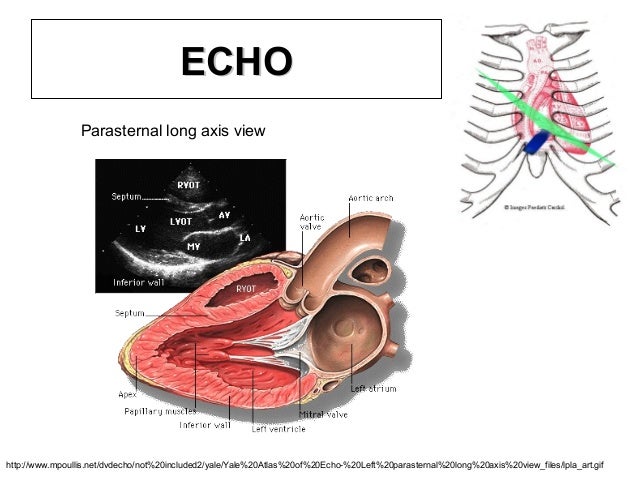 Systolic anterior motion of mitral valve - SAM