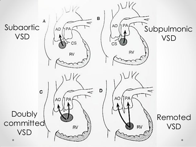 Topic Critical Congenital Heart Disease