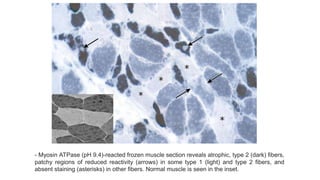 Critical Illness Neuropathy & Myopathy | PPTX
