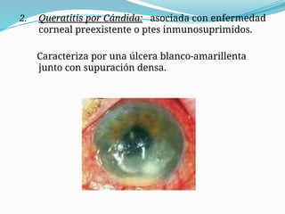 CÓRNEA Queratitis-2 ABORDAJE Y TRATAMIENTO .pptx