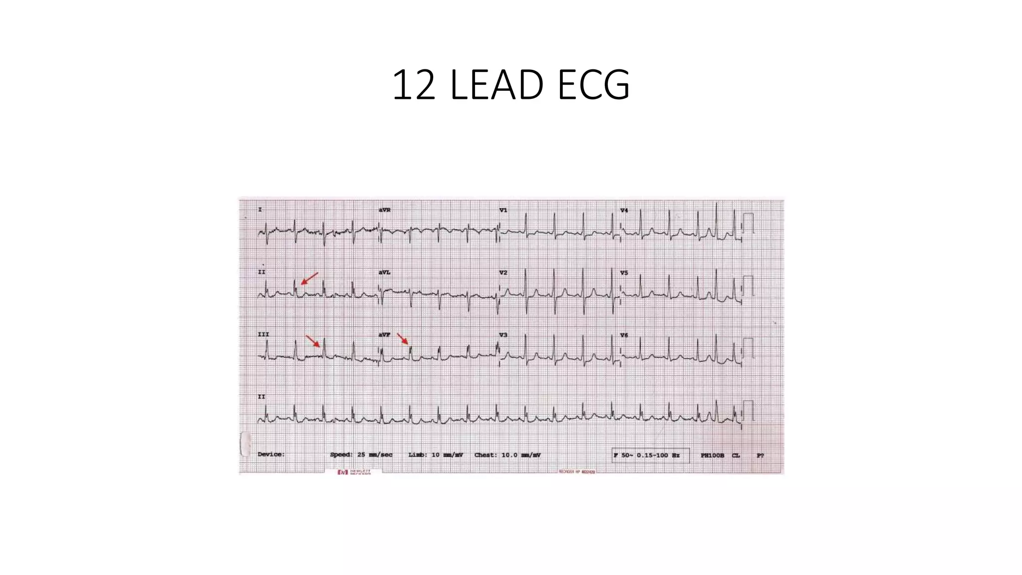 Crochetage sign | PPT