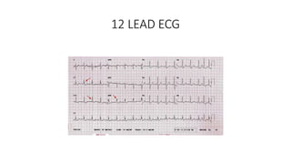 Crochetage sign | PPT