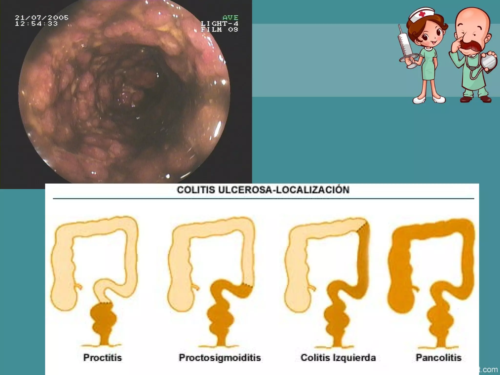 Enfermedad Intestinal Inflamatoria (CUCI Y CROHN) | PPT