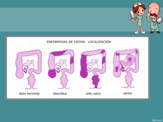Enfermedad Intestinal Inflamatoria (CUCI Y CROHN) | PPT