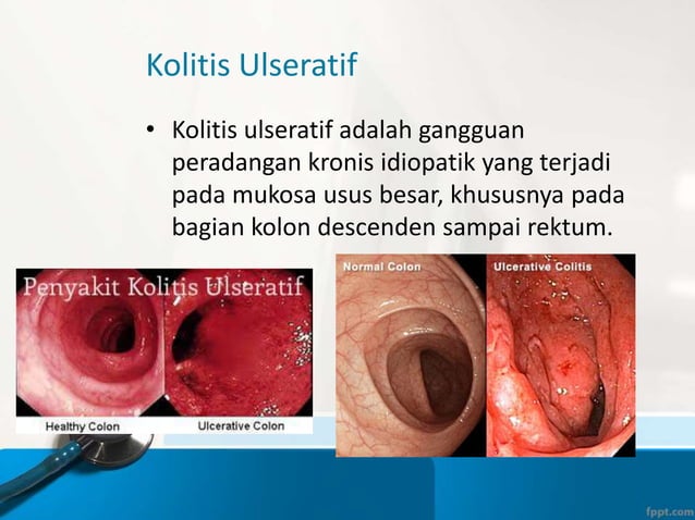 Crohn dan kolitis ulseratif | PPTX