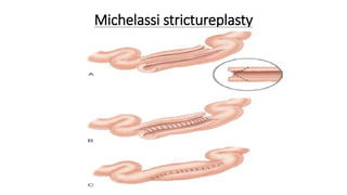 Crohn’s disease and Crohn’s related stricture: Case based discussion ...