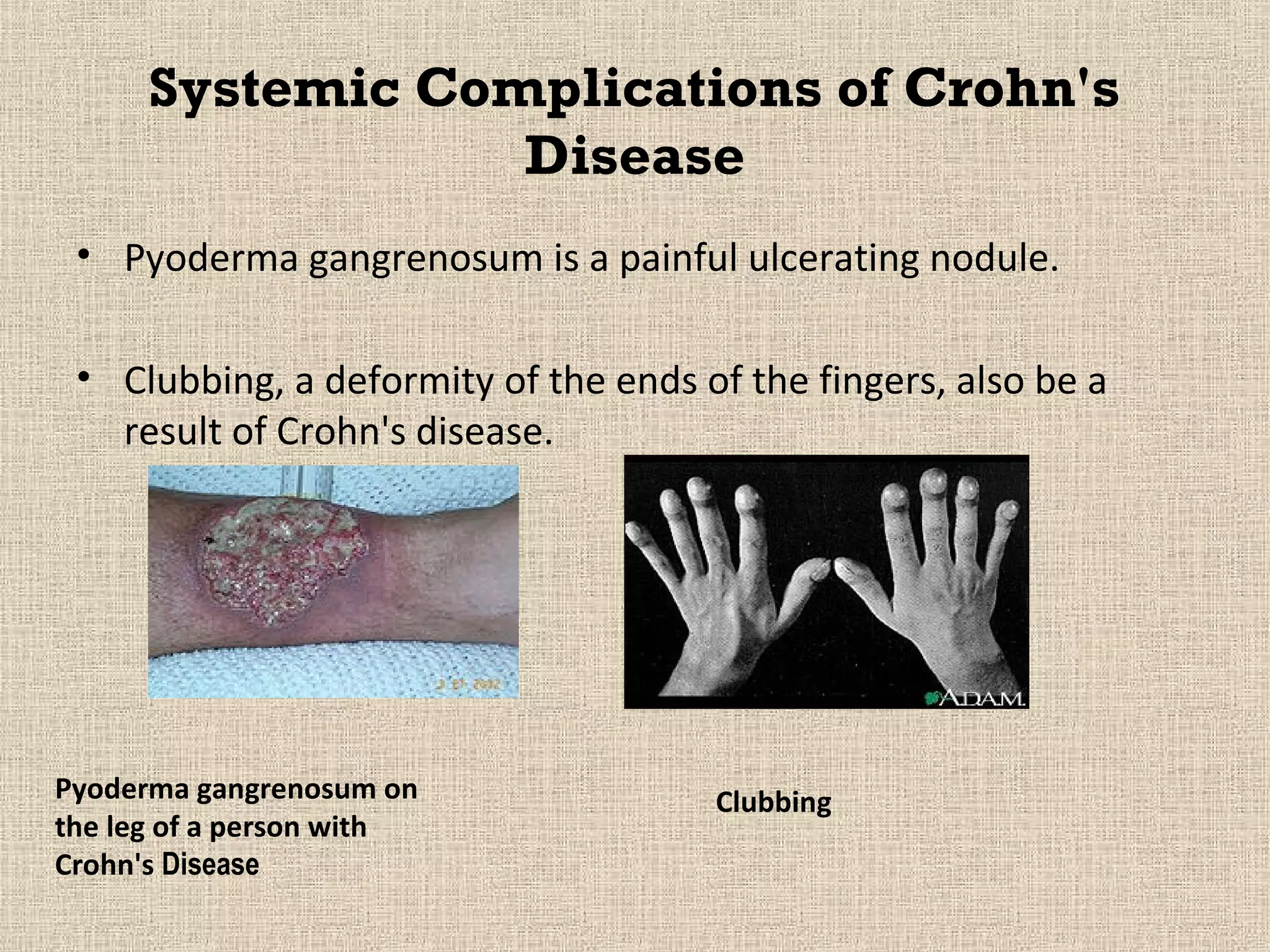 Crohn\'s disease | PPT