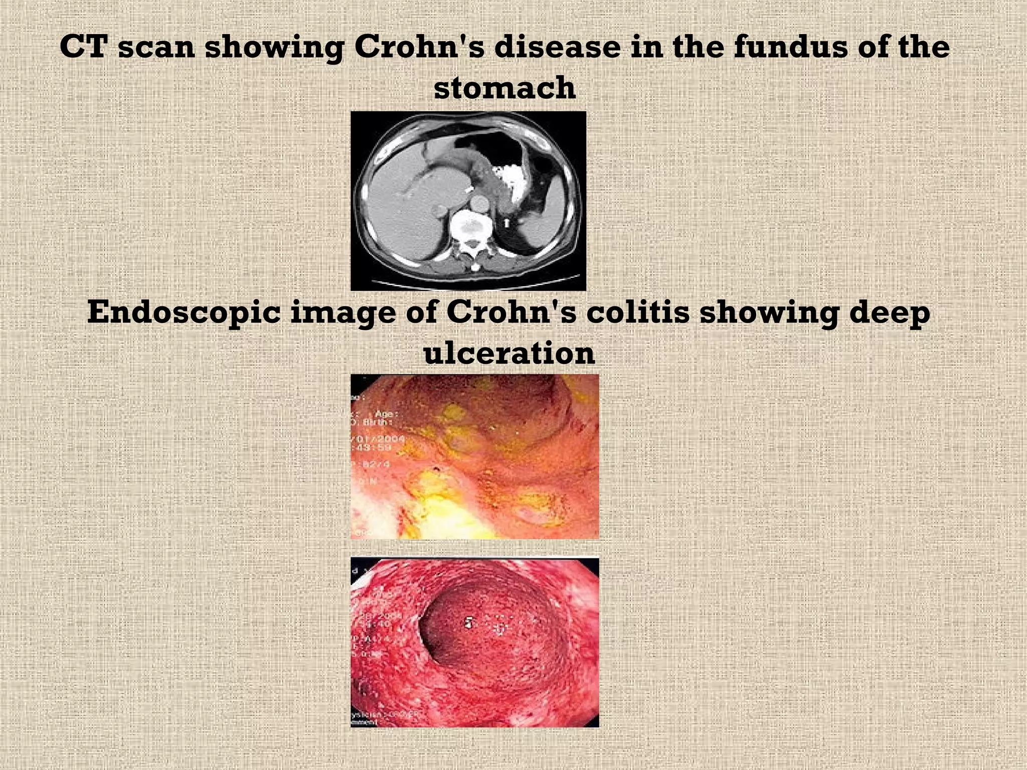 Crohn\'s disease | PPT