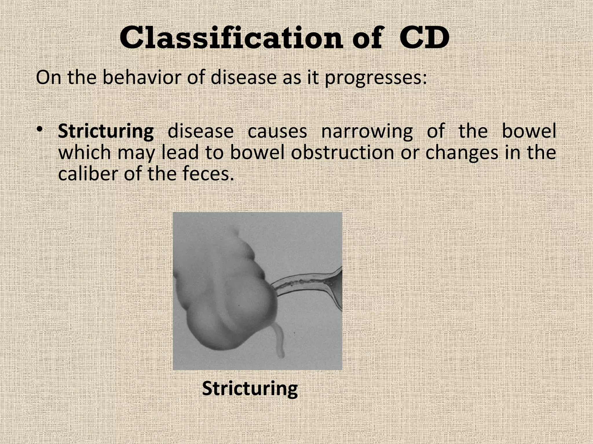 Crohn\'s disease | PPT