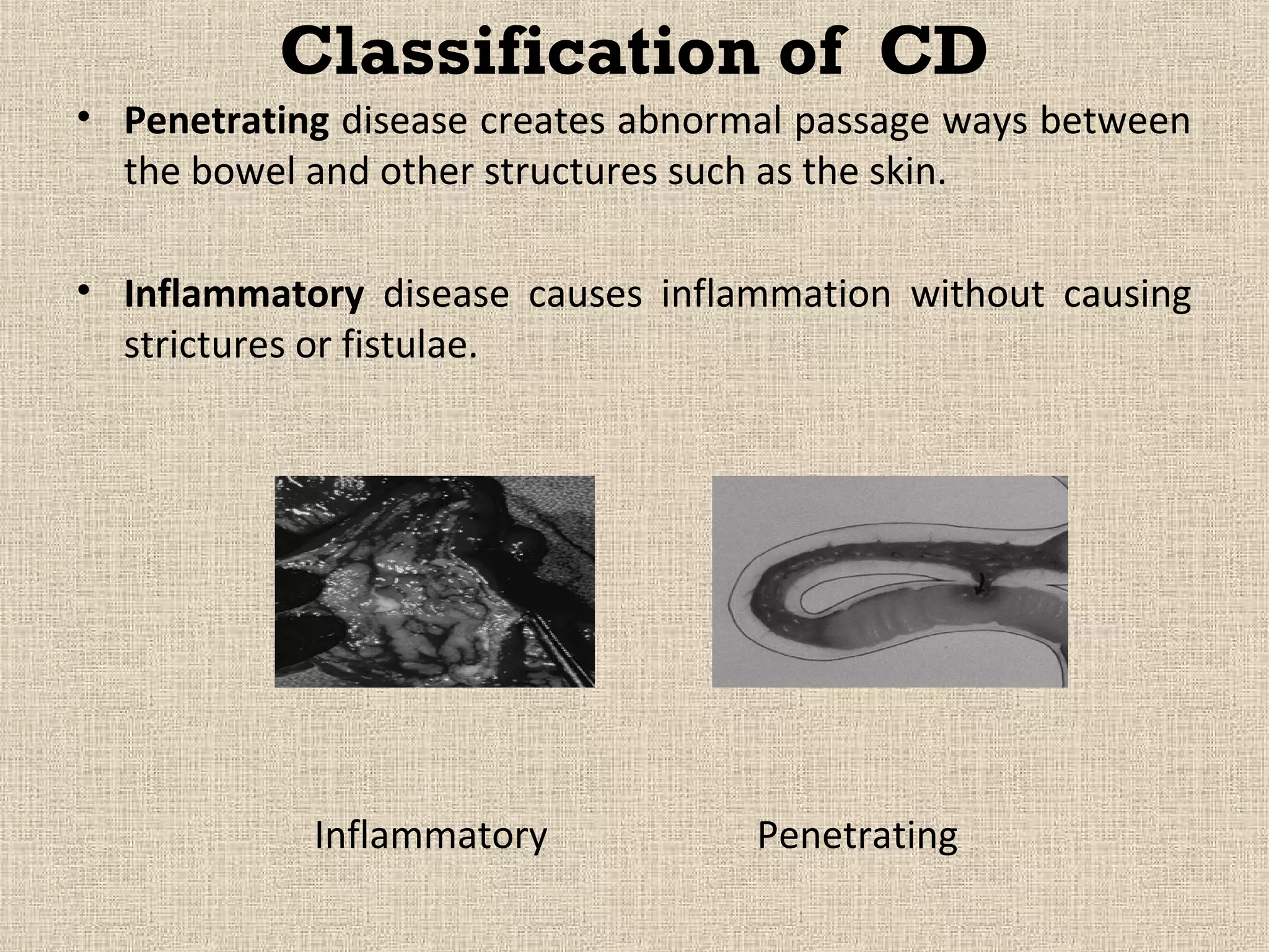 Crohn\'s disease | PPT