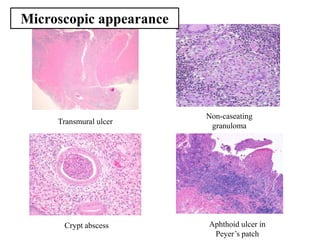 pathogenesis of Crohn's disease presented on KMC,kol july, 2013 | PPTX