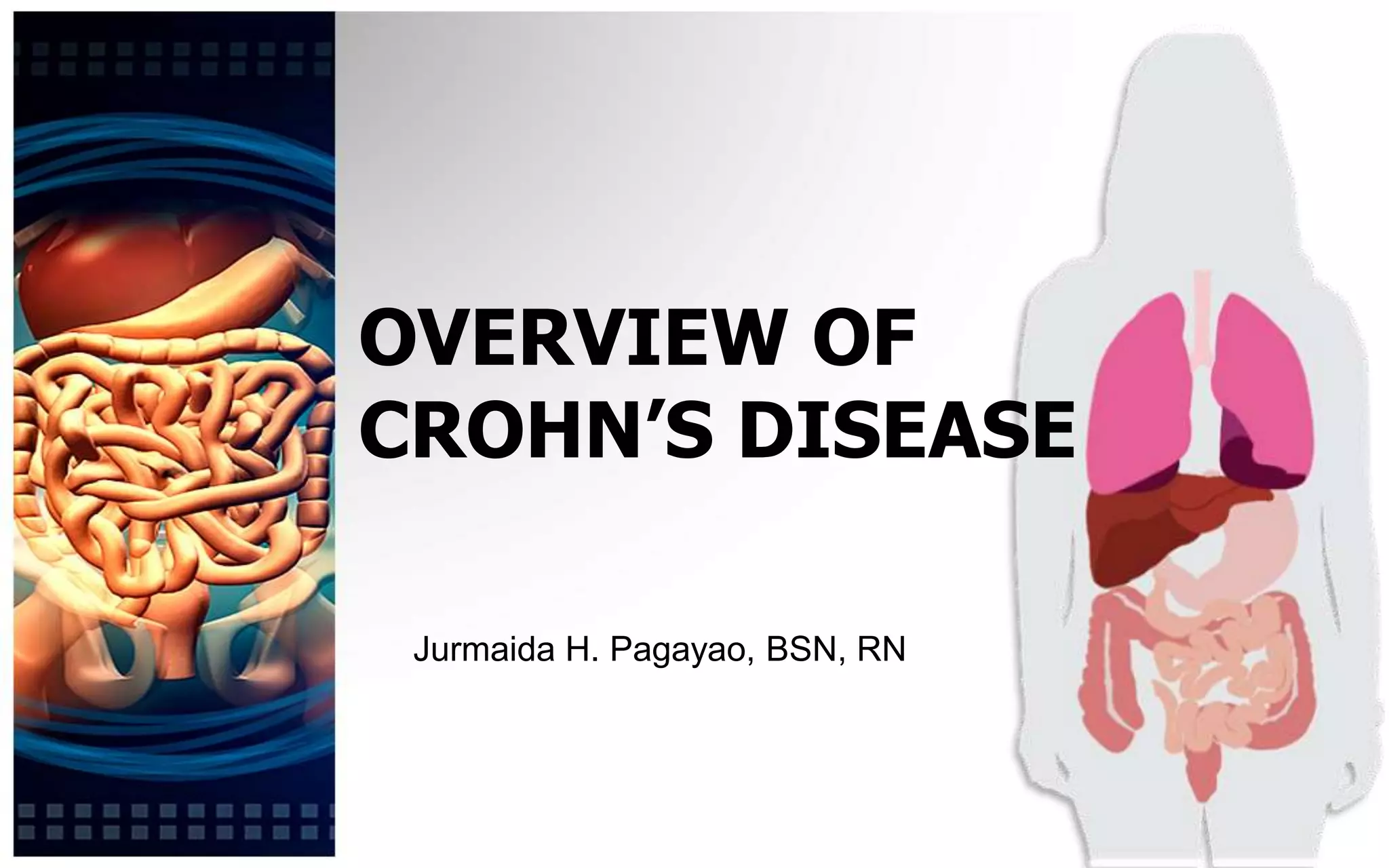 Crohn’s disease | PPTX