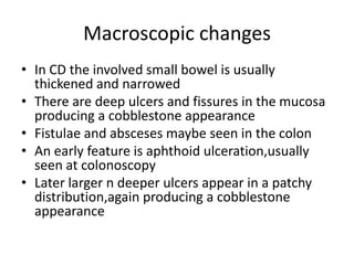 Crohn’s disease | PPT