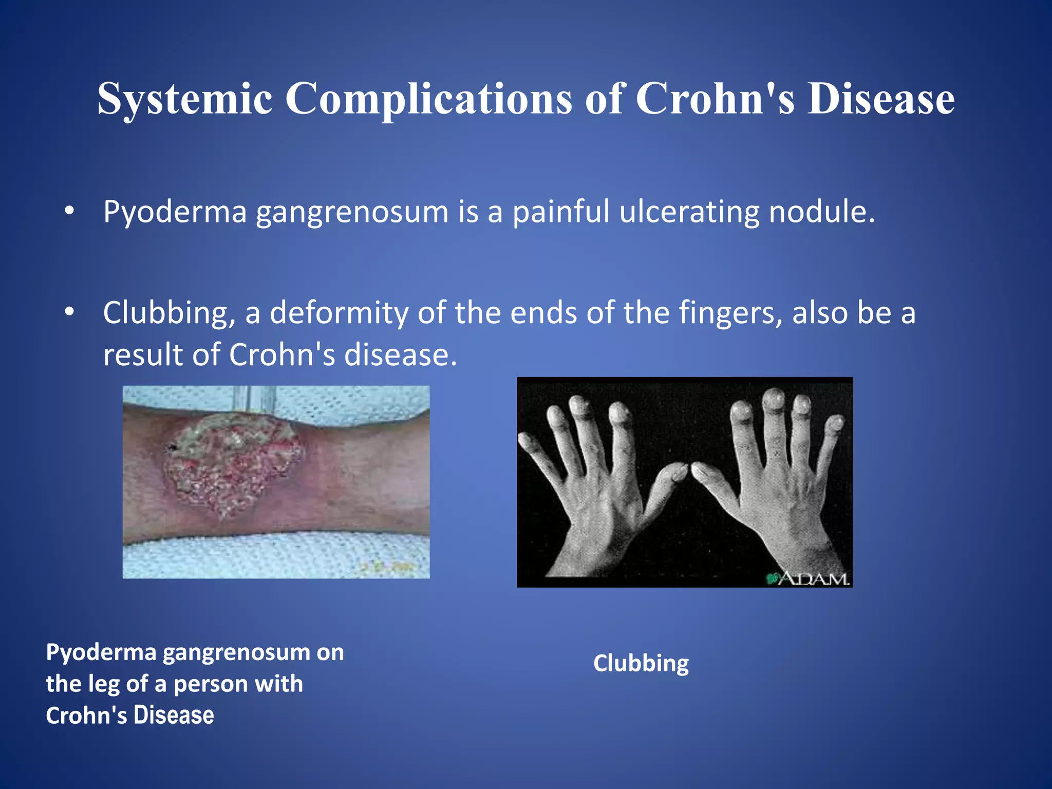 Crohns disease | PPTX