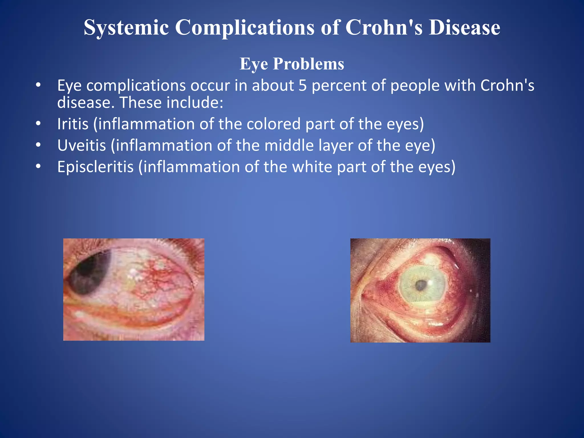 Crohns disease | PPTX