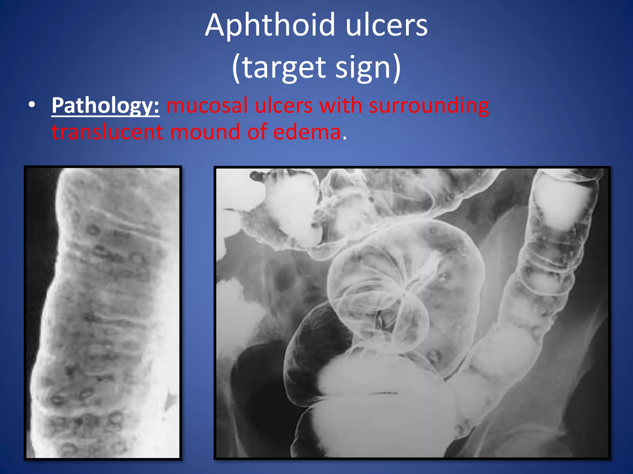 Crohns disease | PPTX