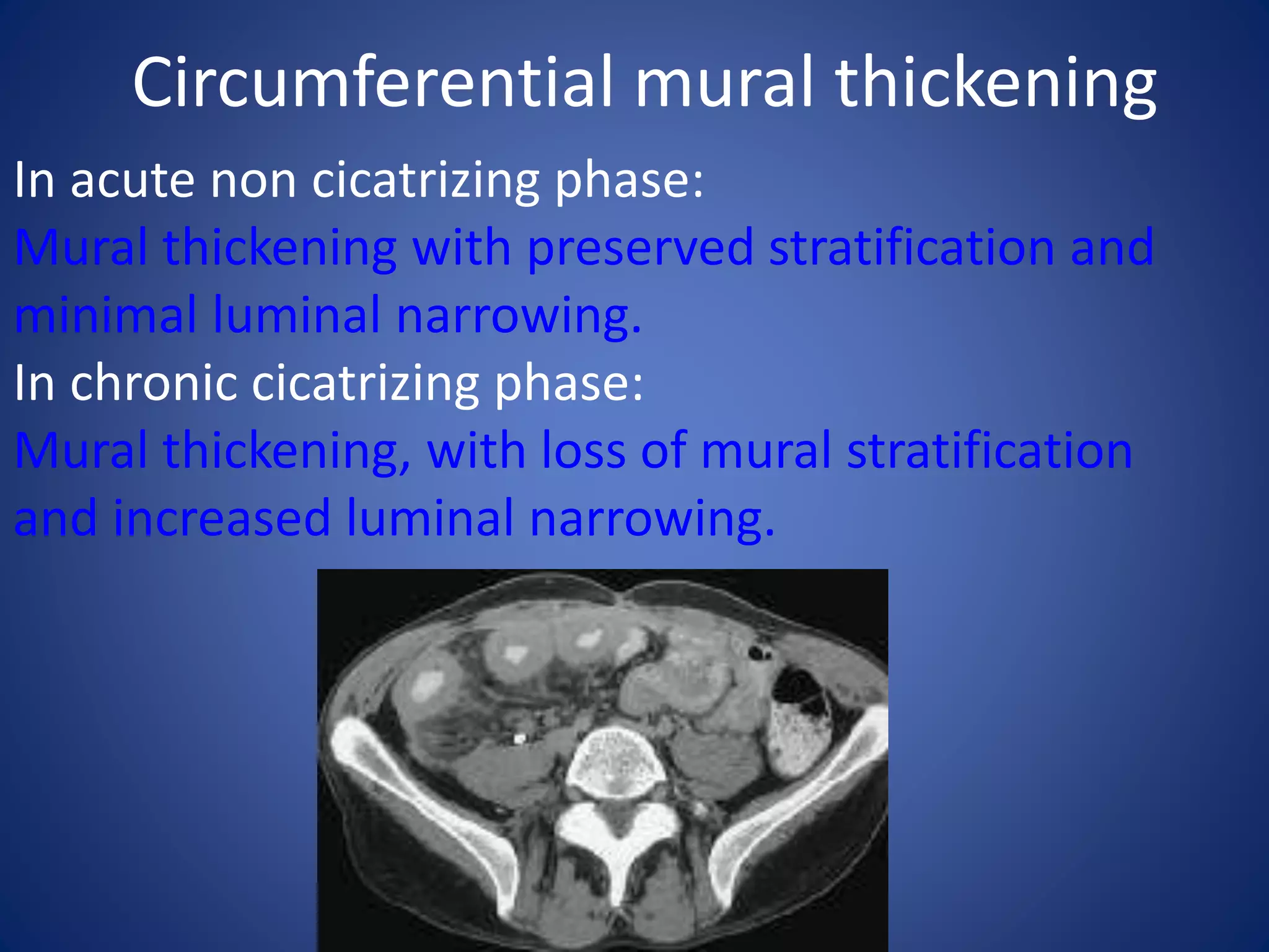 Crohns disease | PPTX