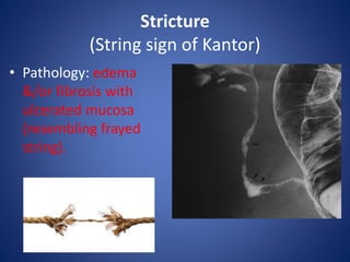 String Sign Crohns Disease