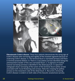 Crohns disease | PDF | Digestive Disorders | Diseases and Conditions