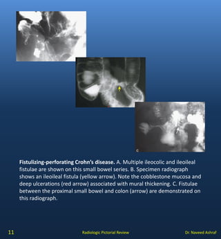 Crohns disease | PDF